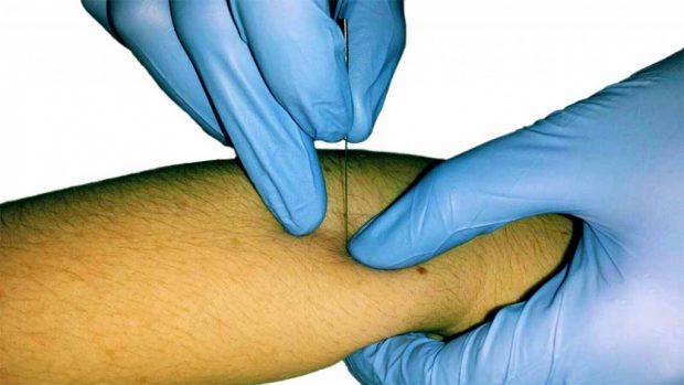 Punción seca (Dry needling): una técnica segura y eficaz